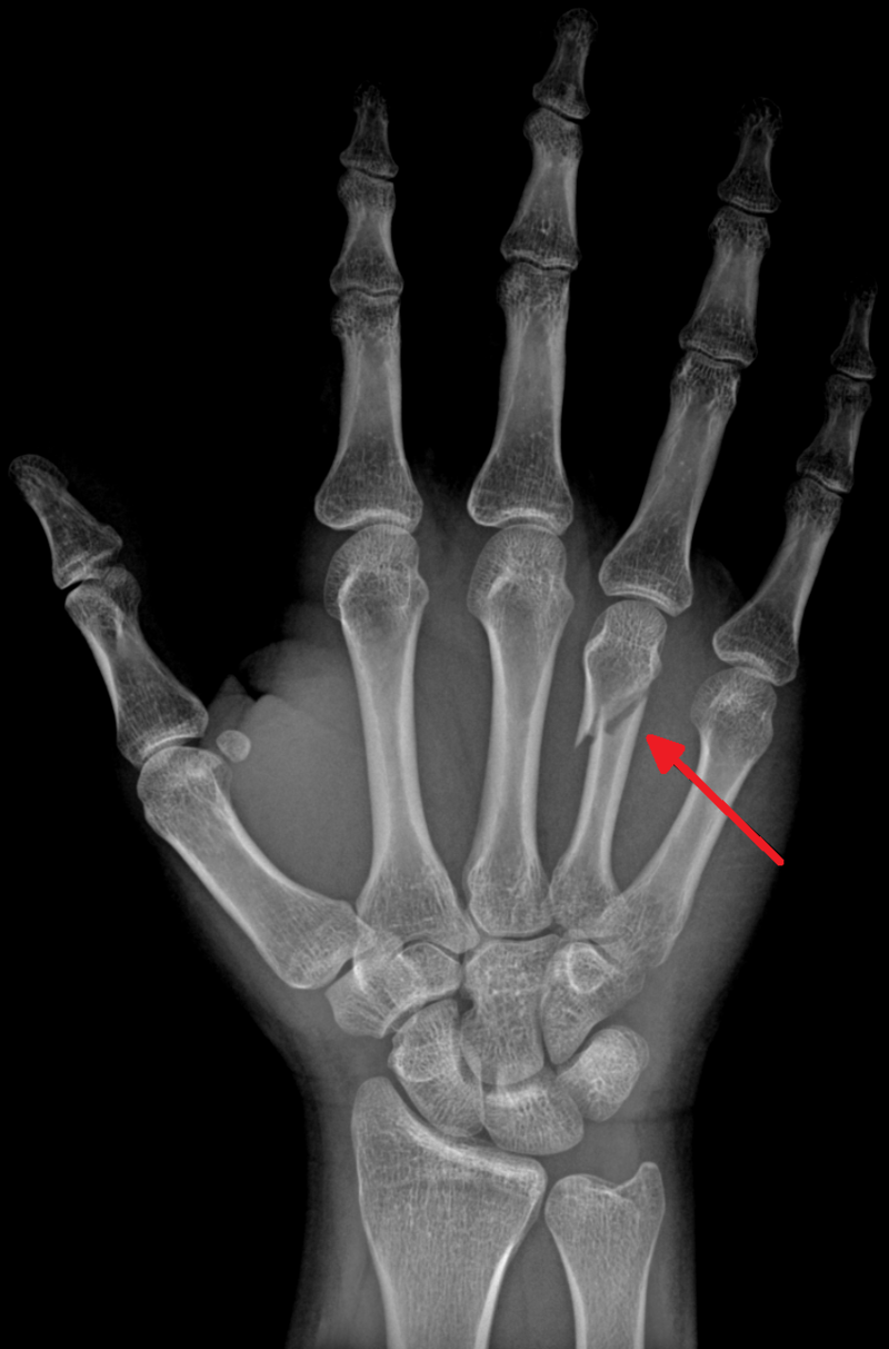 Fourth Metacarpal Shaft Fracture - Rxharun