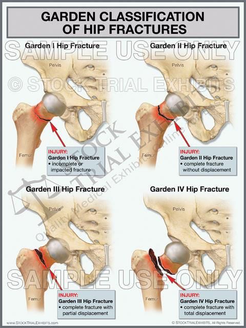 Garden Classification of Subcapital Femoral Neck Fractures - Rxharun