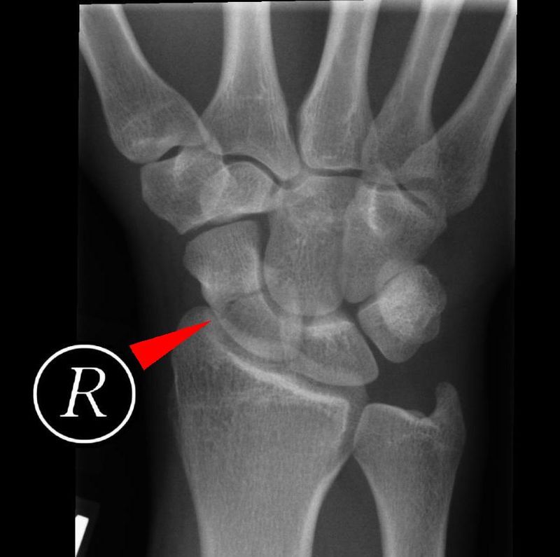 Scaphoid Bone Fracture - Rxharun