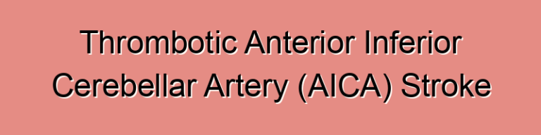 Thrombotic Anterior Inferior Cerebellar Artery (AICA) Stroke
